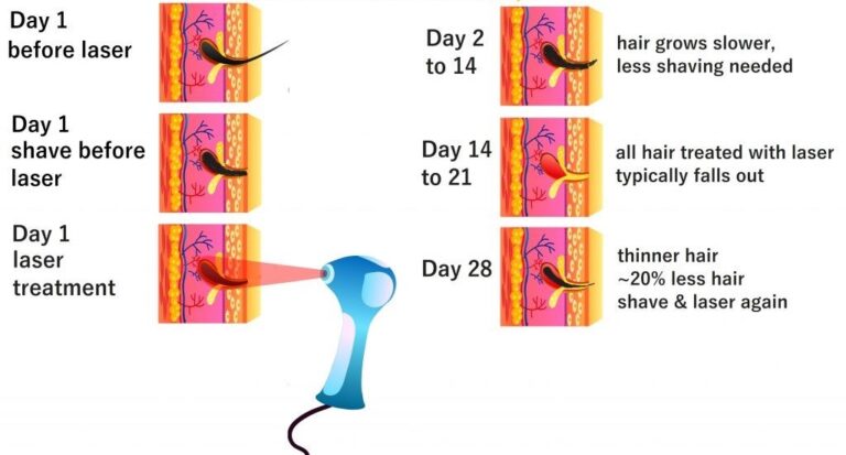 Best Laser hair reduction in Hyderabad